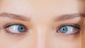 Correcting Squint: Understanding Strabismus & Treatment